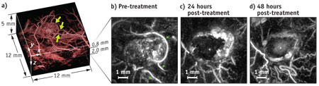 PHOTOACOUSTICS: In-vivo photoacoustic scanner images tumor vasculature ...