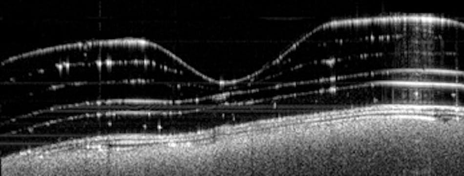 OPTICAL COHERENCE TOMOGRAPHY/TISSUE PHANTOMS: A physical eye model for ...
