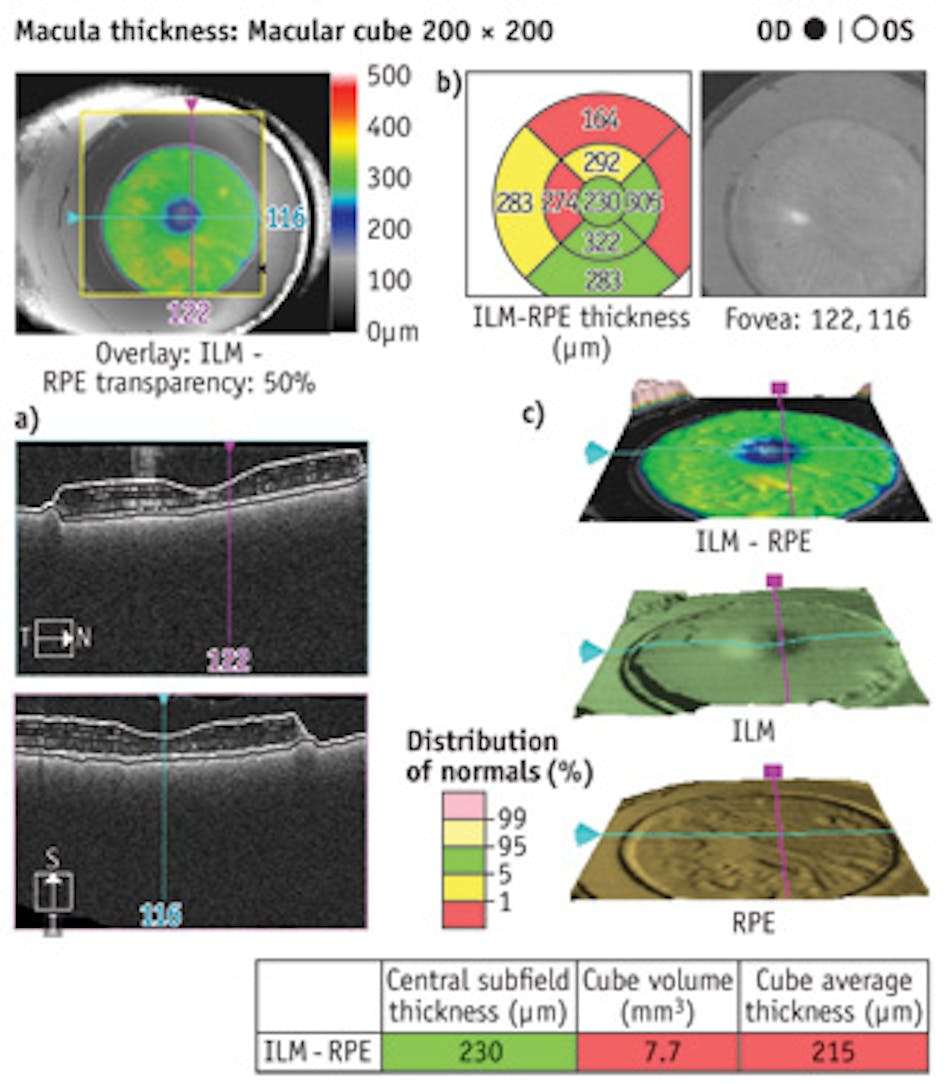OPTICAL COHERENCE TOMOGRAPHY/TISSUE PHANTOMS: A physical eye model for ...