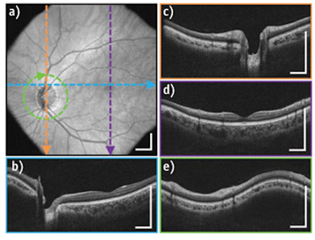 PRIMARY CARE SCREENING/OCT/DISEASE DETECTION: Handheld OCT device ...