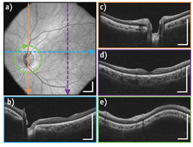 PRIMARY CARE SCREENING/OCT/DISEASE DETECTION: Handheld OCT device ...
