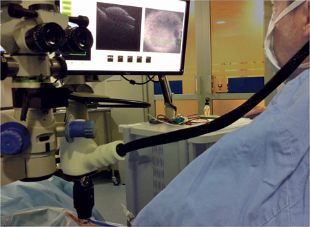 OPTICAL COHERENCE TOMOGRAPHY/OPHTHALMOLOGY: Intraoperative OCT improves ...