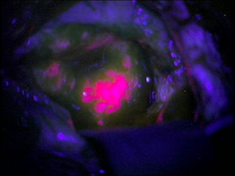 Handheld fluorescent probe assists in brain cancer surgery | Laser ...