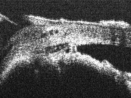 Bioptigen begins shipping SD-OCT system capable of 1 µm axial ...