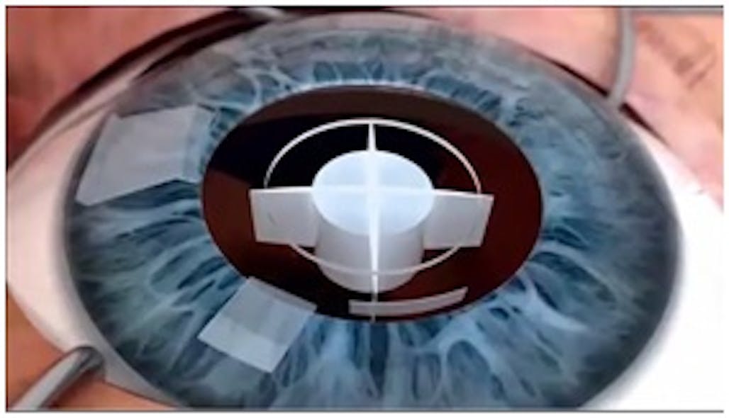 Femtosecond laser surgery affected by cavitation bubble dynamics ...