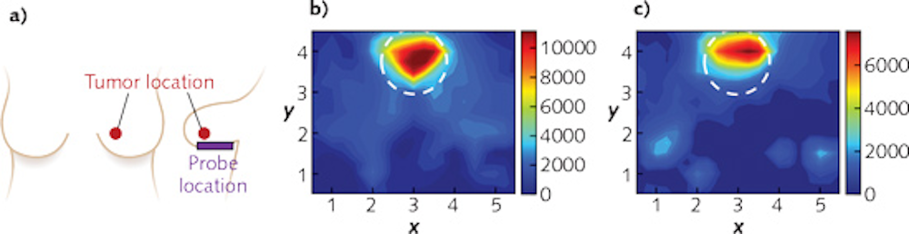 3D Imaging: External optical probe images breast cancer in 2D—3D ...