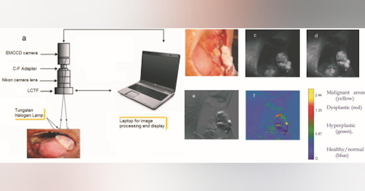 Diffuse reflectance imaging validated for early, noninvasive tumor ... Diffuse reflectance imaging validated for early, noninvasive tumor ...