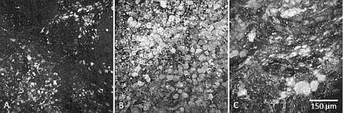 Direct measurement of laser weld depth with inline coherent imaging ...
