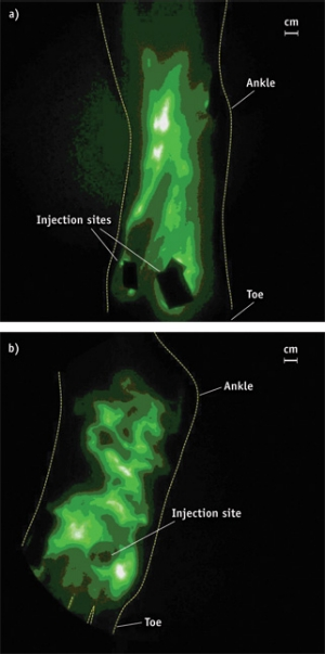 NEAR-INFRARED IMAGING/ONCOLOGY: NIR fluorescence images lymphatics to ...