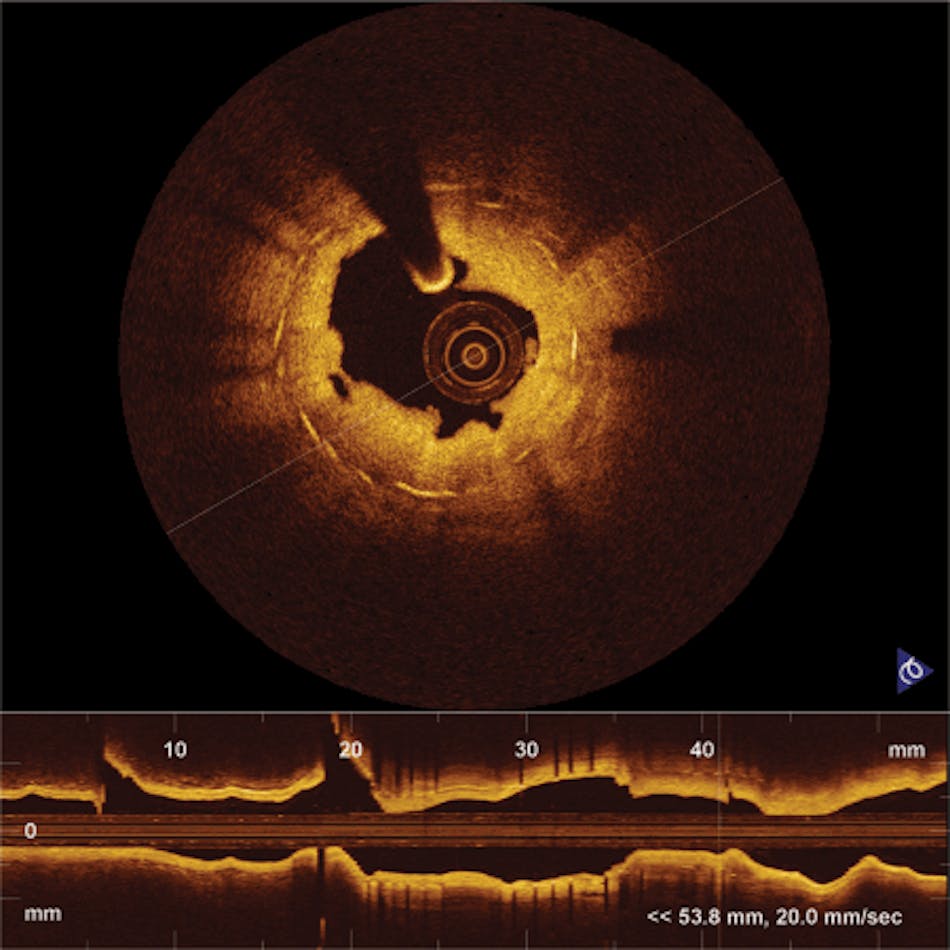 OPTICAL COHERENCE TOMOGRAPHY/CARDIOLOGY: Totally tubular ...