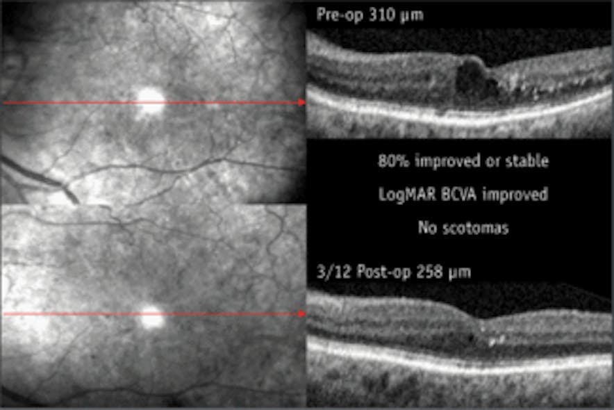 Nonthermal laser treatment targets macular degeneration | Laser Focus World