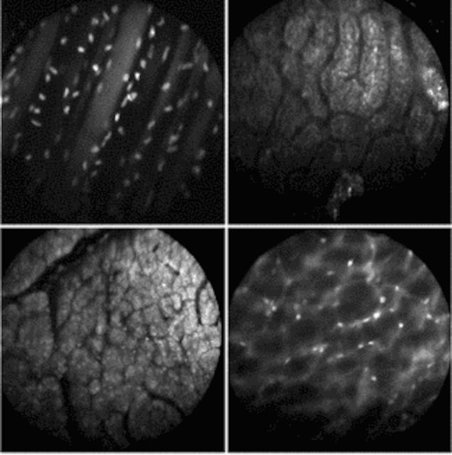 Microendoscopy takes diagnostics deeper into the body | Laser Focus World