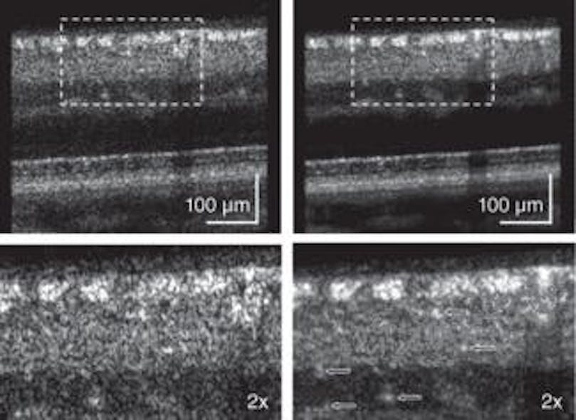 MEDICAL OCT: Ultra-high-resolution optical coherence tomography gets ...
