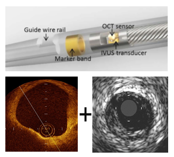Optical Coherence Tomography Vs Ivus