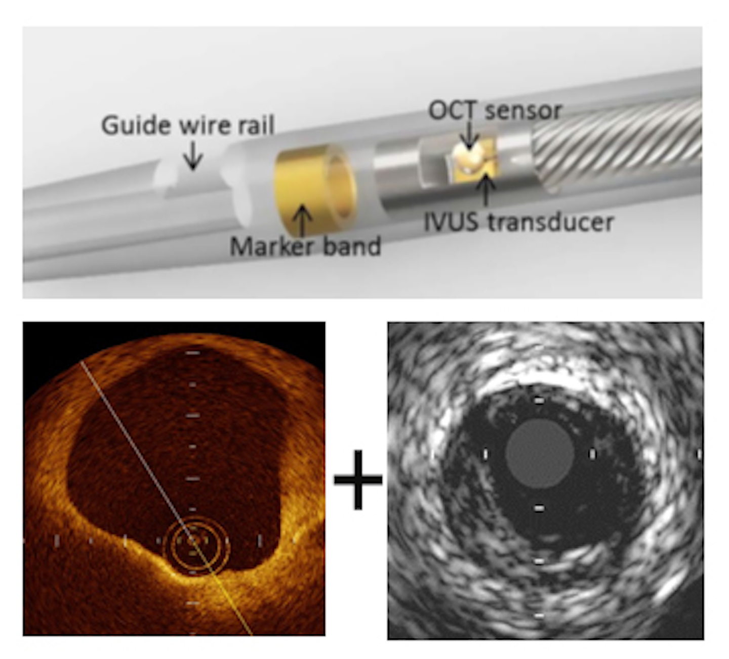 OCT, IVUS imaging pair to better detect dangerous plaques in arteries ...