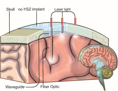 Optically transparent skull implant shows promise for laser treatments ...