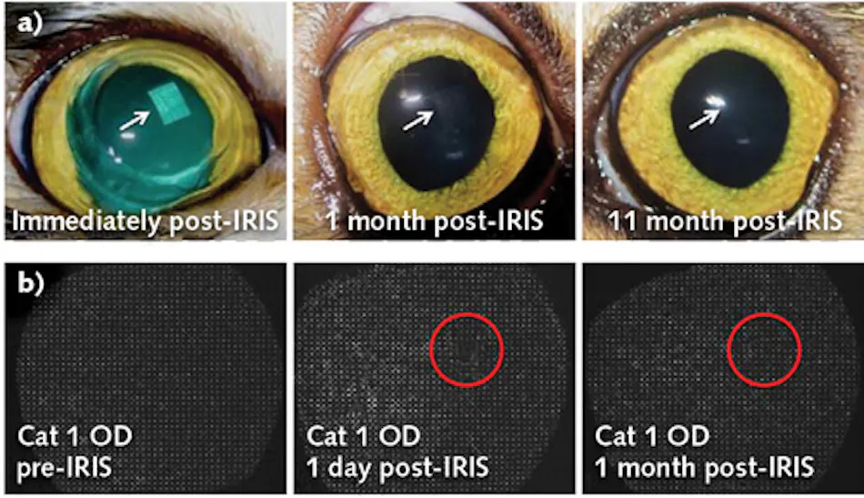 Ophthalmology/Femtosecond Lasers: LIRIC: Next-generation refractive ...