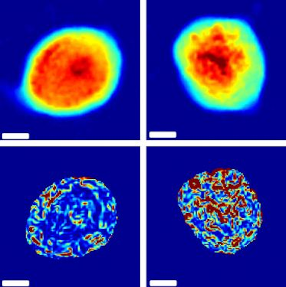 Laser technique can examine, at high speed, individual cancer cells to ...