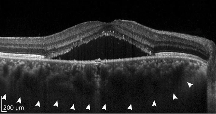 Deep learning for OCT image analysis | Laser Focus World