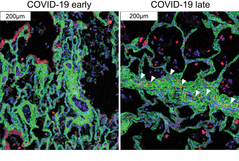 Imaging cytometry method details lung pathology in COVID-19 | Laser ...