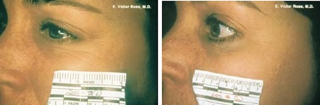 Smoothbeam puts wrinkle removal in hands of primary-care physicians ...