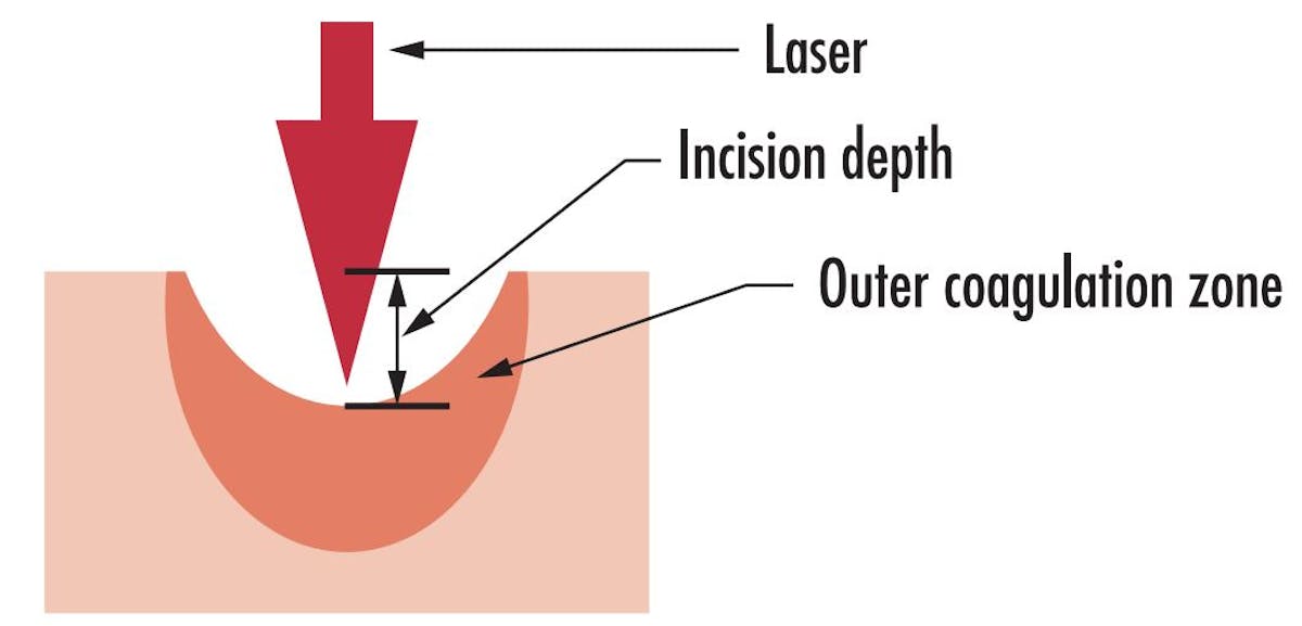 Medical applications are a surgical fit for 2 µm lasers | Laser Focus World